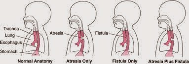 Santi Rahayu: Kelainan Pada Esophagus