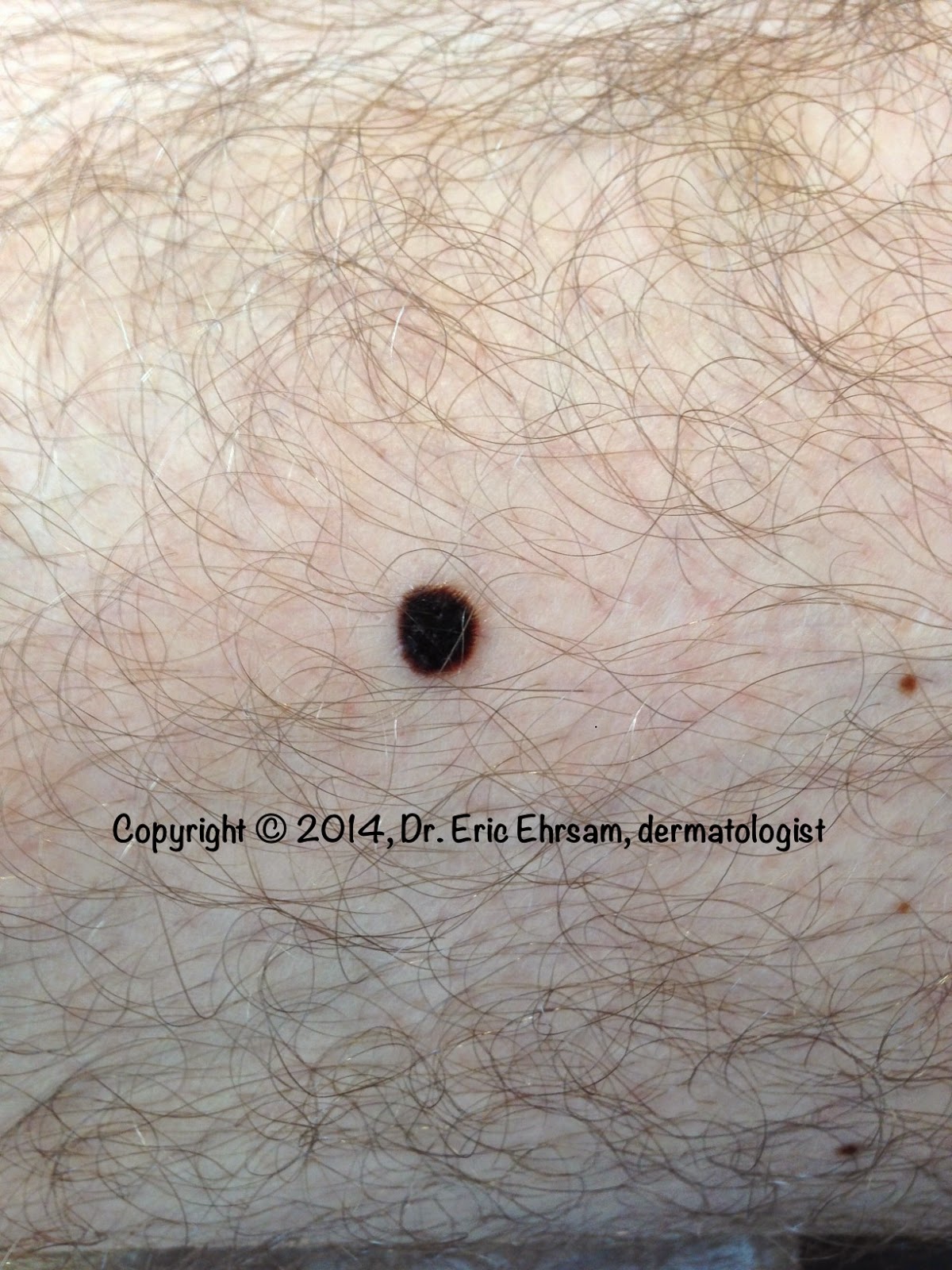 dermoscopy: Starburst pattern