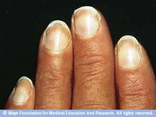 HealthyThyroidLady ™: WHAT COLOR IS YOUR LUNULA?