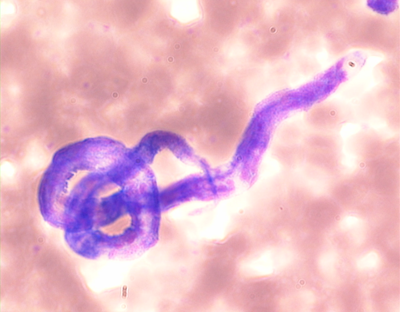 Loa-loa (cacing loa, cacing mata) ~ Examination and Happiness