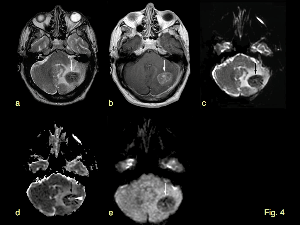 MRI BLOG: Pitfalls of Diffusion Weighted Imaging