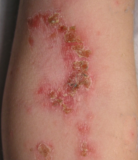 Health and Safety: Impetigo : Symptoms, Causes and Home Remedies