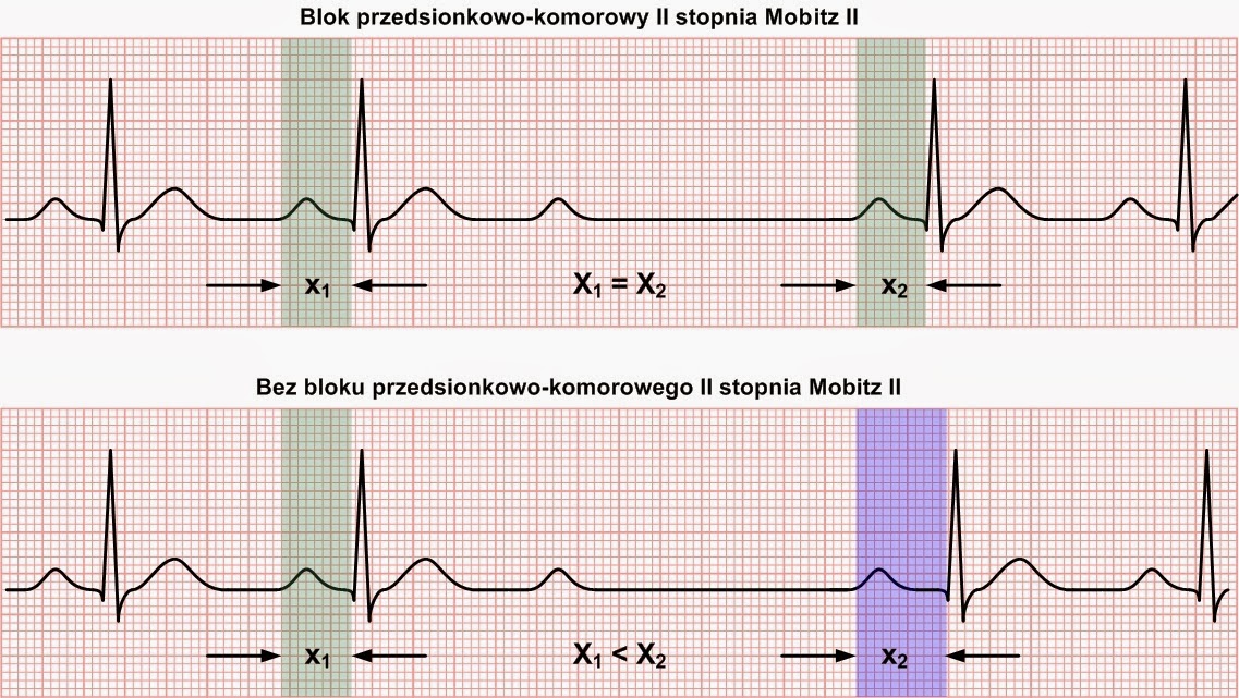 Kardiologia ratunkowa i nie tylko... : Rozpoznanie bloków przedsionkowo ...