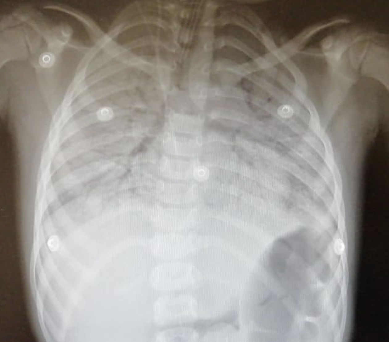 INTENSIVOS PEDIATRICOS: MANEJO DEL PARDS