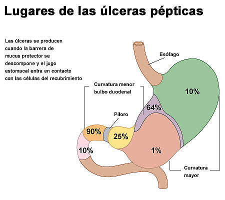 Fisiopatología Humana: Úlcera Péptica