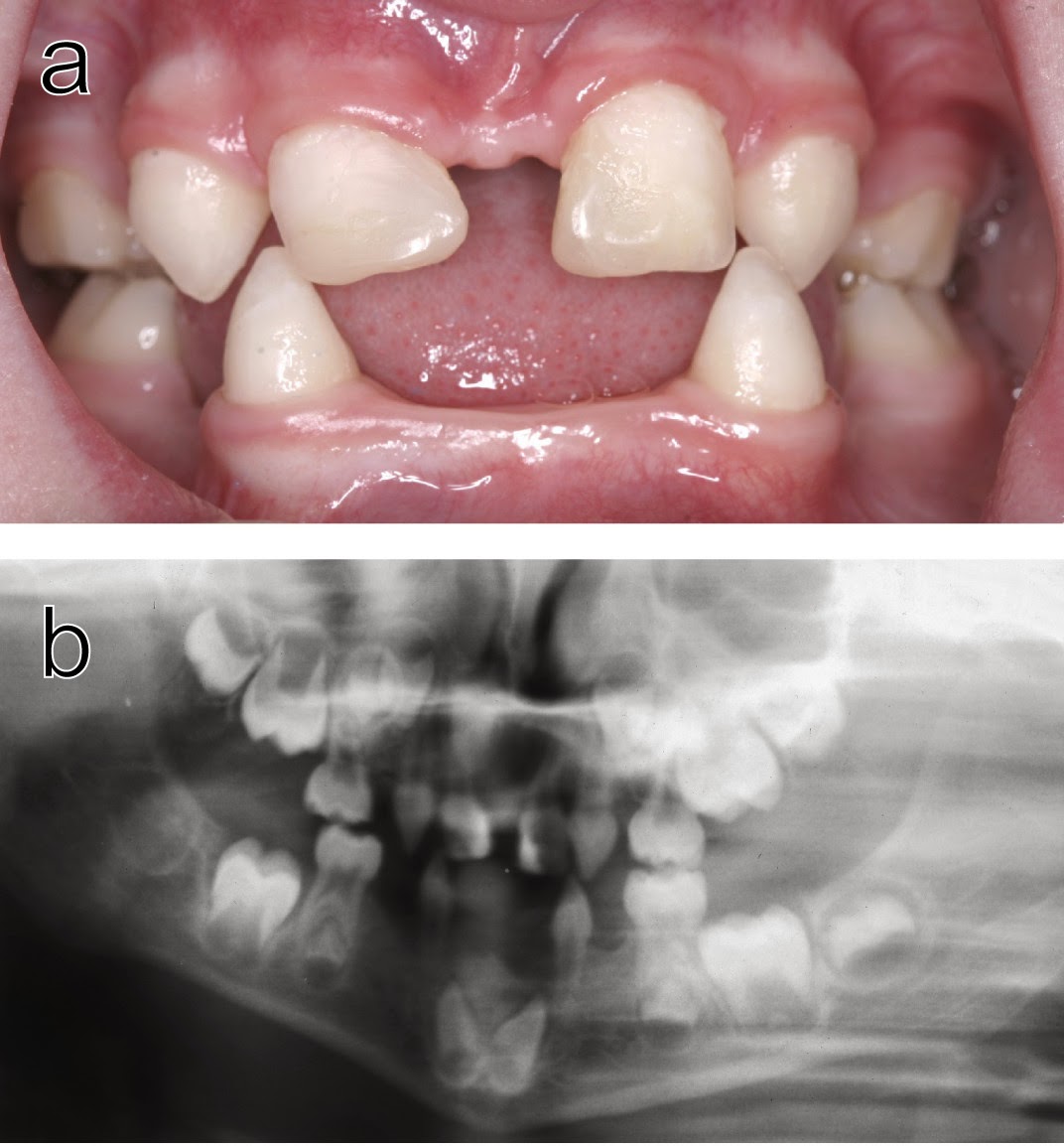 Estomatologia Online: Síndromes - Displasia Ectodérmica