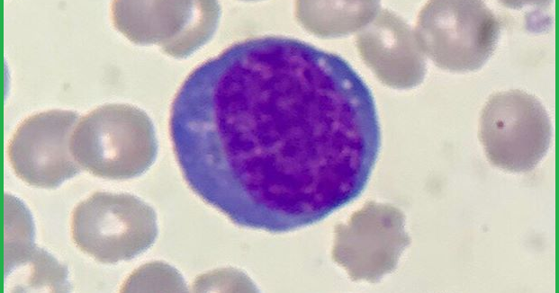 Linfócitos atípicos - Bioonerd