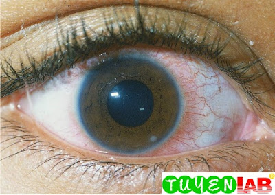 [Emergency] ATLAS OF CORNEAL ULCER | Free Medical Atlas