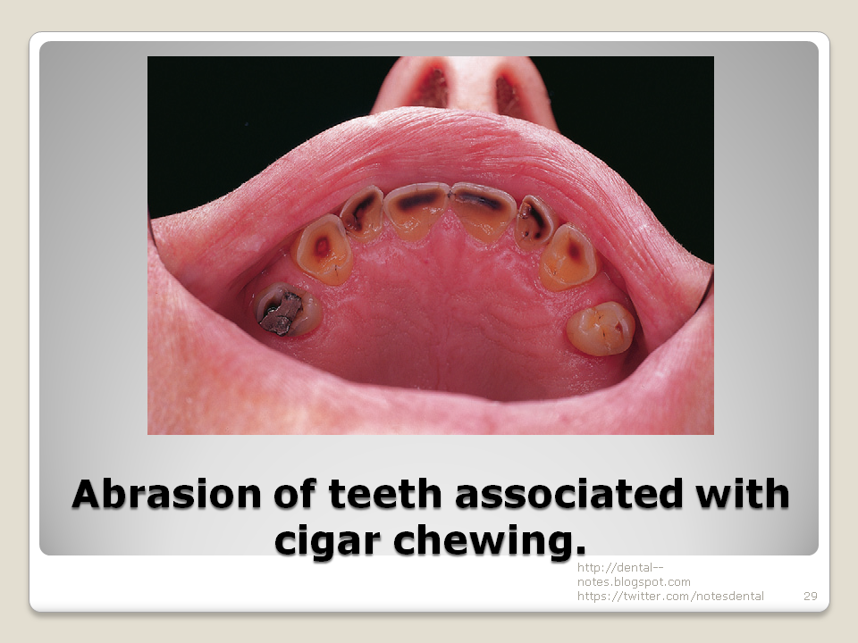 Dental Notes: Abnormalities of Teeth (Alterations in Shape) NOTES