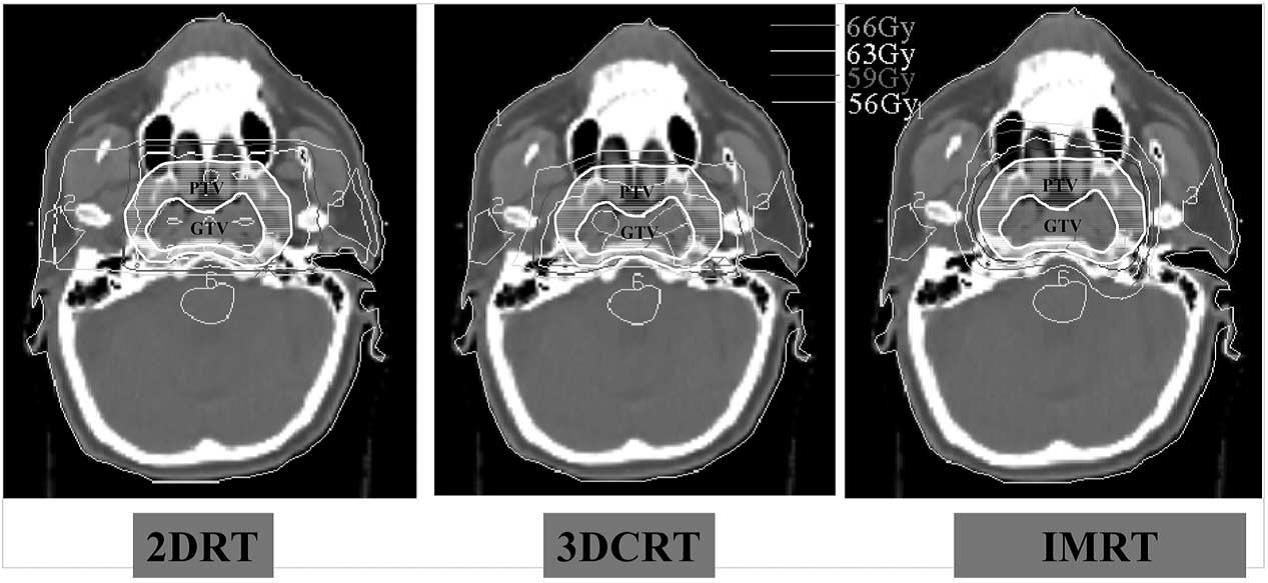kembara kehidupan: 3D CONFORMAL RADIOTHERAPY FOR NPC
