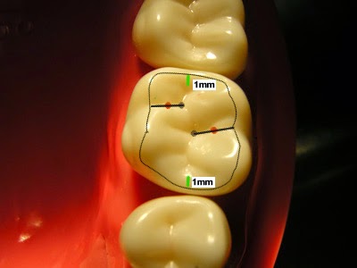 Operative Dentistry: Class I Cavity preparation & restoration on ...