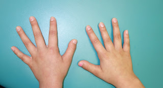 Short Fingers- Brachydactyly | Congenital Hand and Arm Differences ...