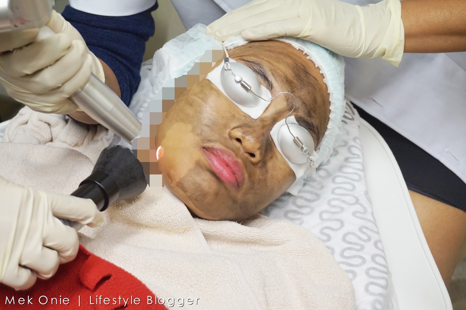 Pengalaman Laser Muka Di Premier Clinic,TTDI - Mek Onie