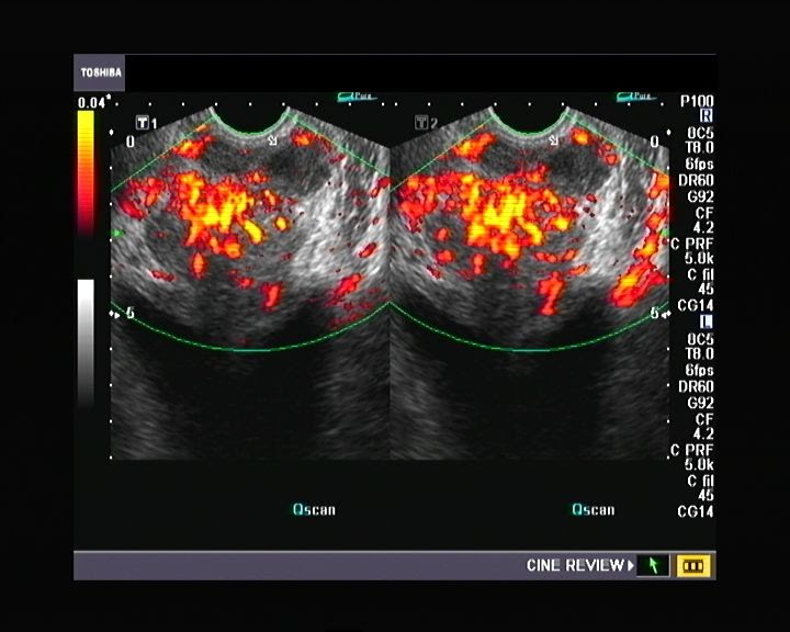 Ultrasound and Color Doppler videos: Prostate -transrectal ultrasound quiz