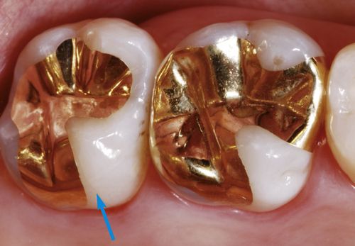 Full Metal Crown - Inlay High Noble - VC-TECH Dental Laboratory