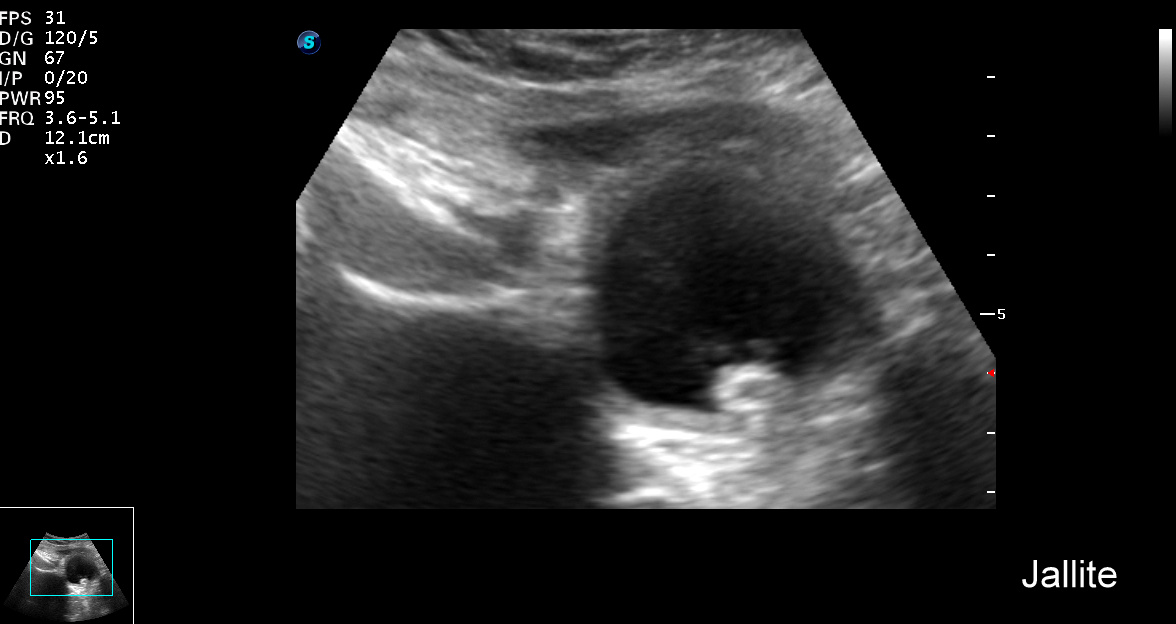 Cistitis Hemorragica Aguda