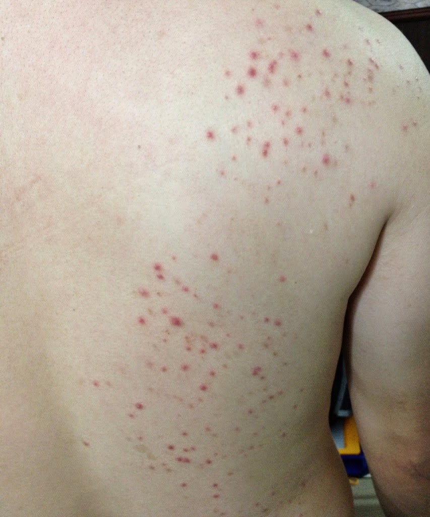 SKIN DISEASE TYPES: Folliculitis Skin Disease Type (Skin Disease Type)