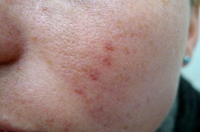 acne vulgaris: Types of Acne Blemishes