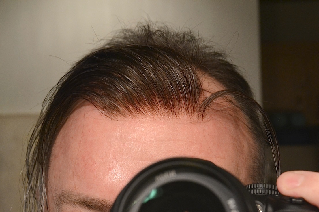 HairSay: New Hairline