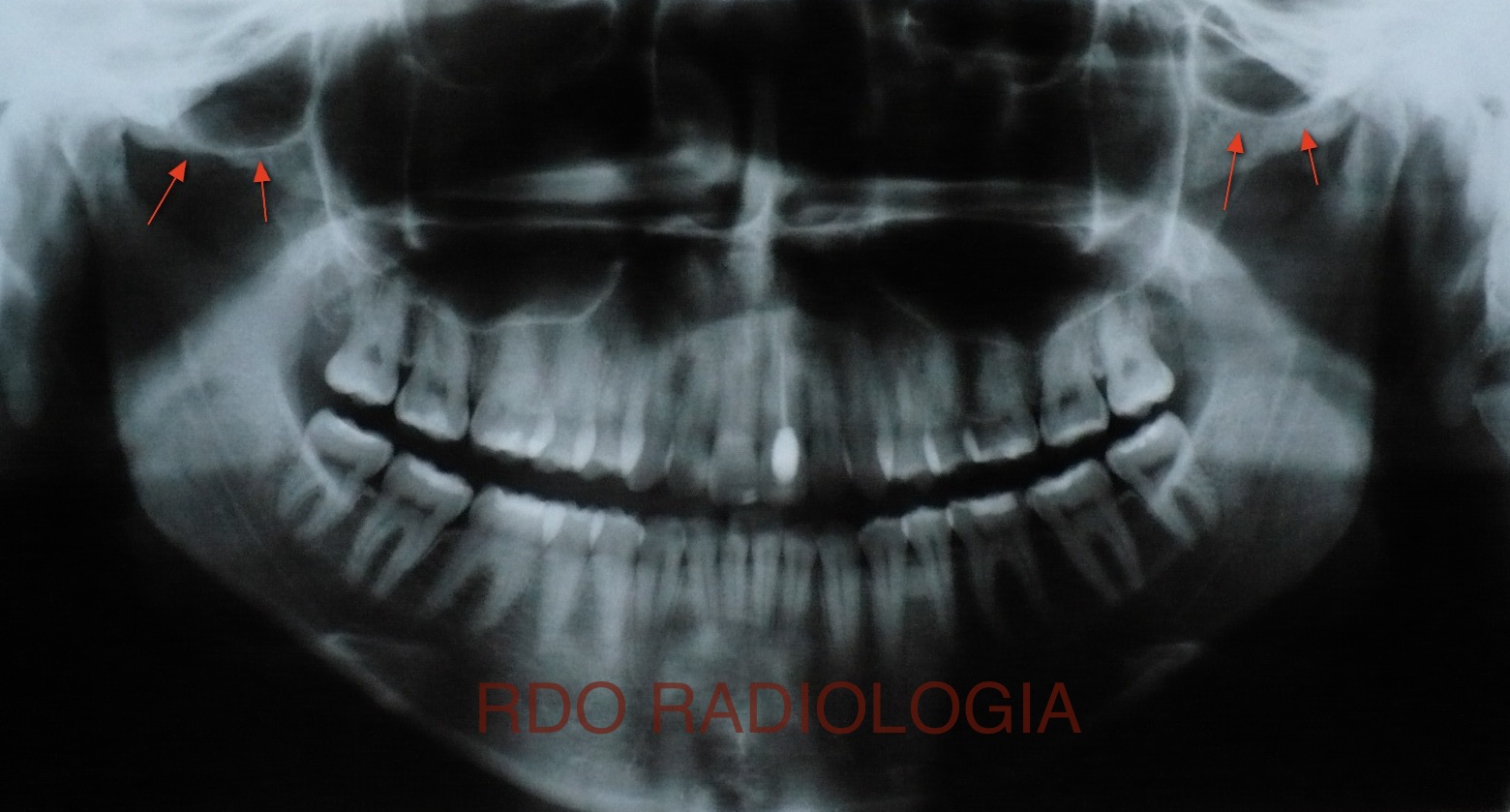 BLOG RDO RADIOLOGIA ODONTOLÓGICA: Pneumatização do seio esfenoidal