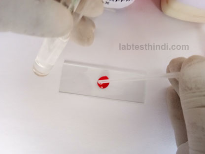 Sickle Cell क्या है | Sickling Test कैसे करते है – ( Slide Method ...