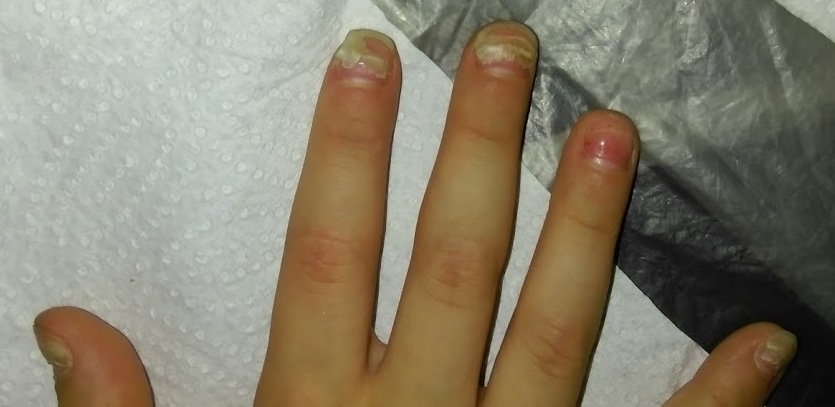 Amr Gohar FRCP UK: Onychomadesis following hand foot and mouth disease