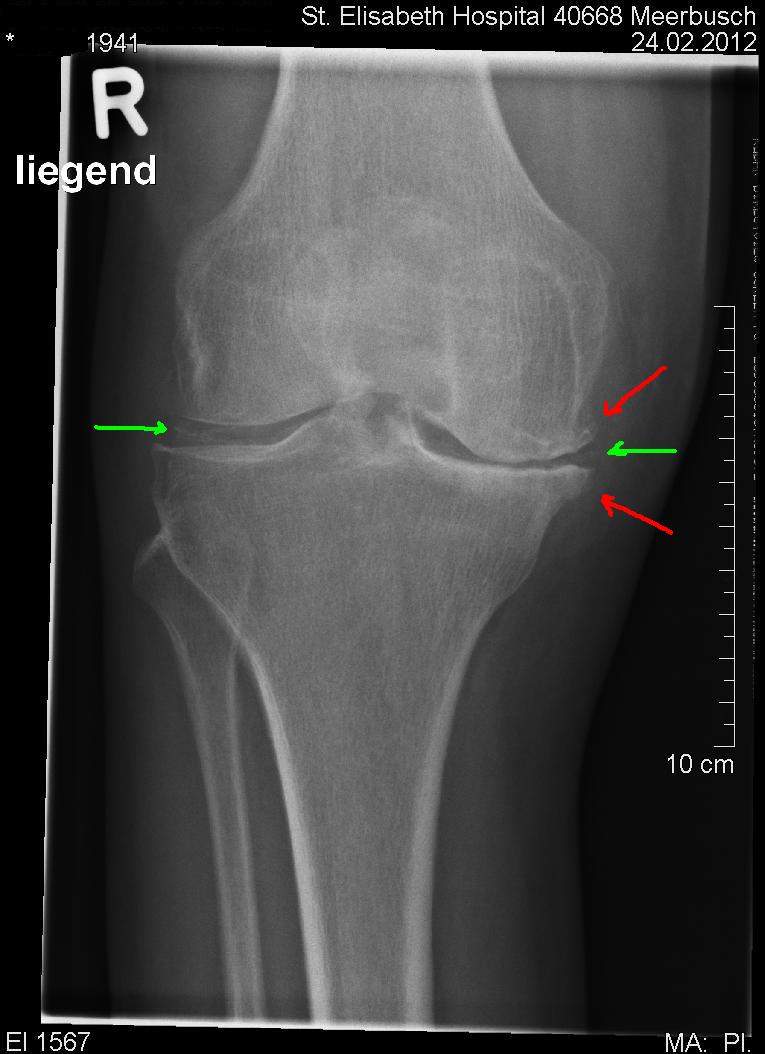 Rheumatologe: Chondrocalcinosis