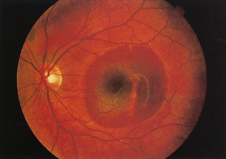 Rajesh DODDA UVEITIES: chorioretinities