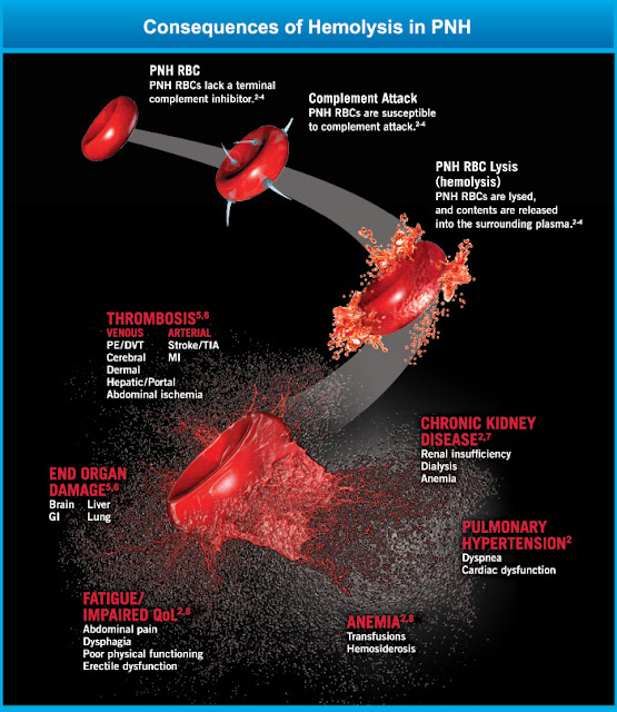 Team Tausha: Team Tausha: The Consequences of Hemoysis and PNH