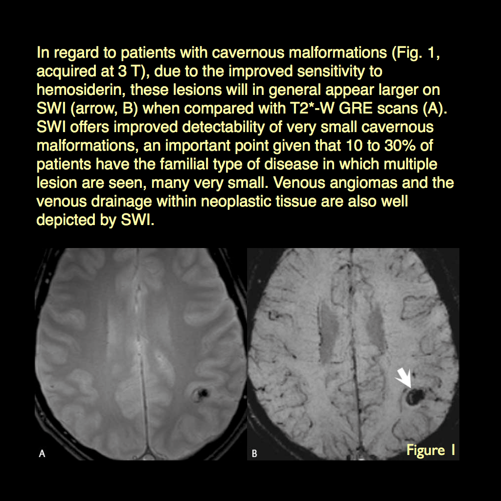 MRI BLOG: Susceptibility Weighted Imaging (I/II)