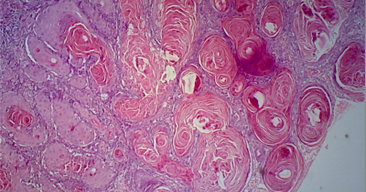 Oral Pathology India: ORAL PATHOLOGY- CARCINOMA CUNICULATUM