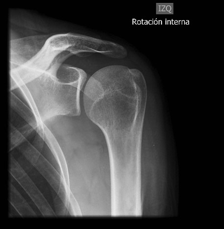 RadioMundo: Radiología de hombro