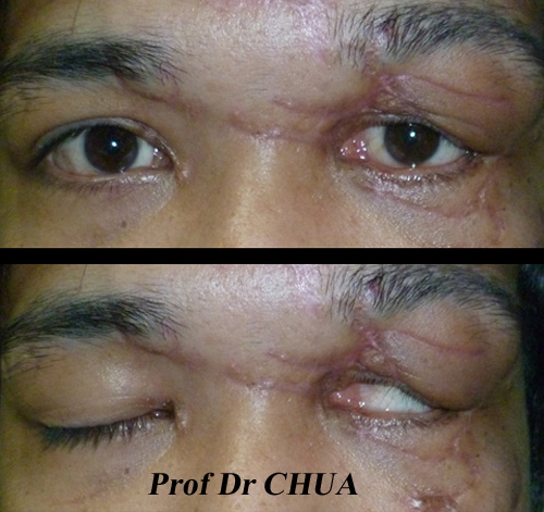Eyelid Surgery by Prof Dr CN CHUA 蔡鐘能: A Patient with Problem Closing ...