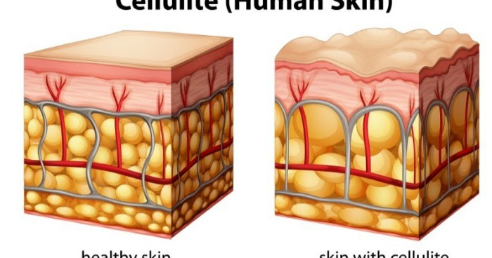 What is Cellulite Treatments That Work? Best Cellulite Treatment 2019 ...