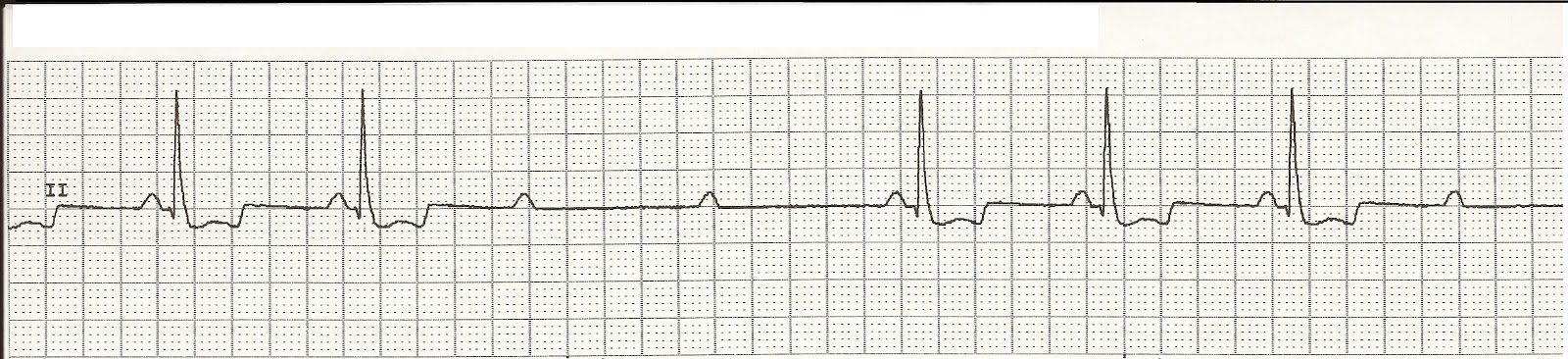 ACLS Rhythms: Heart blocks