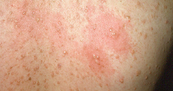 Jenis-Jenis Gejala Alergi dan Pengobatannya | Informasi, Tips dan ...