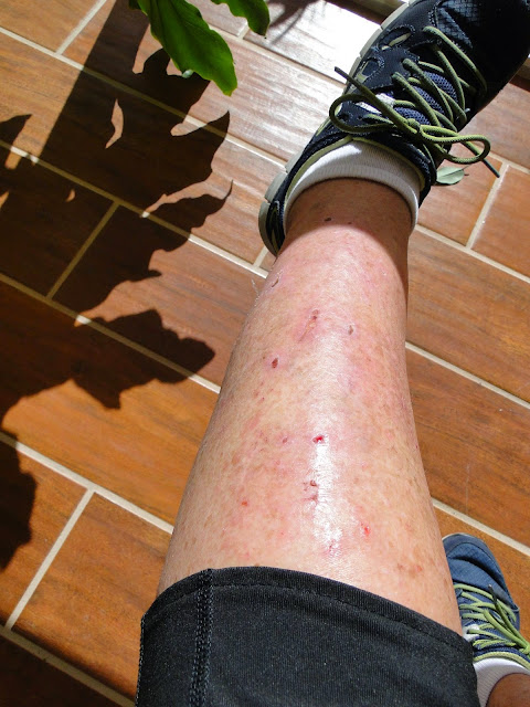 Leg Bites ALIEN ABDUCTIONS EFFECTS leg-bites-alien-abductions-effects