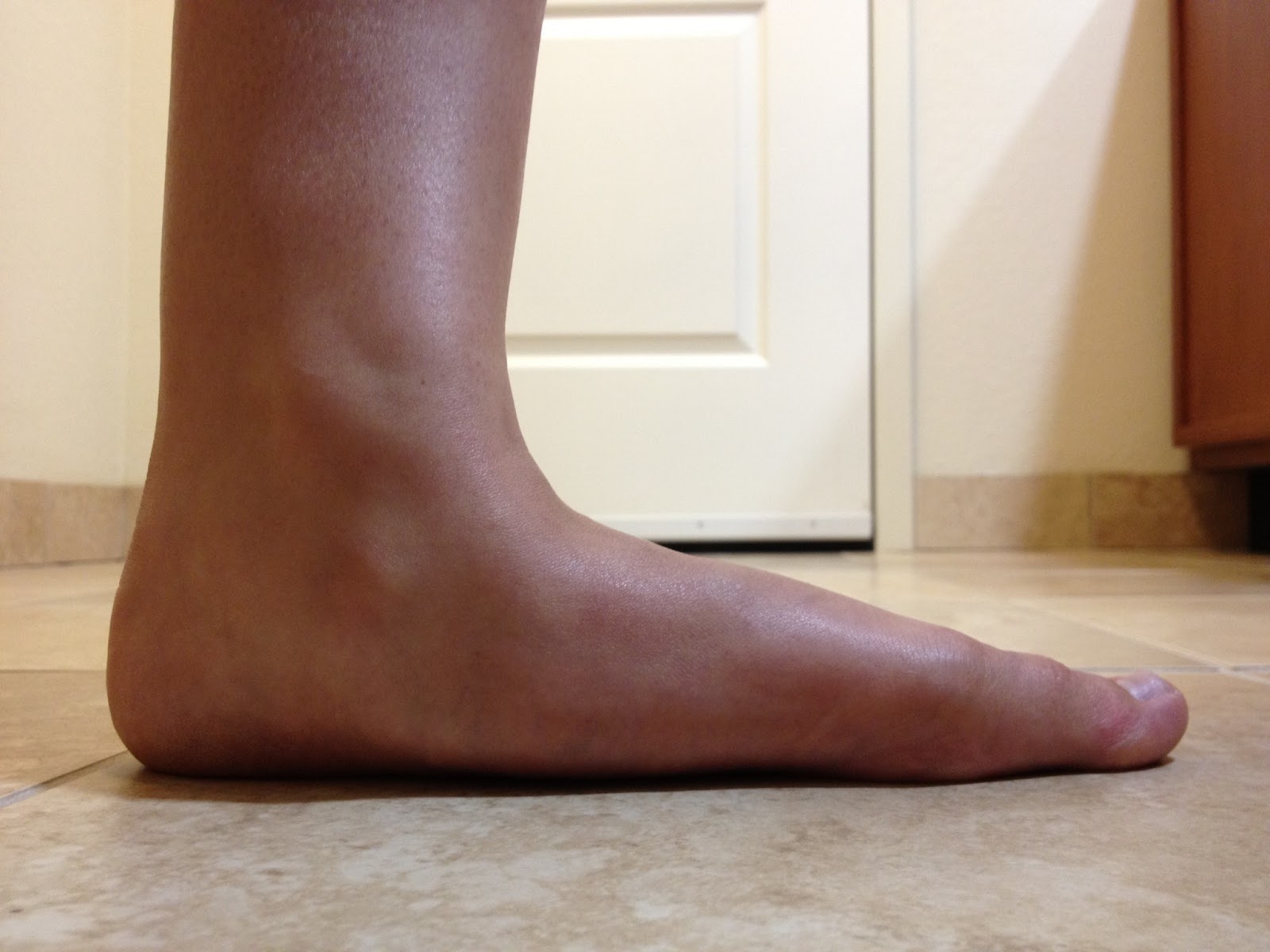 The Road to Two Normal Feet