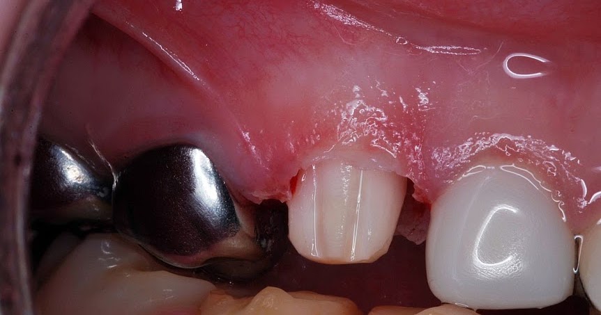 SSC: Using 3M ESPE Stainless Steel Crowns in Pediatric and Everyday ...
