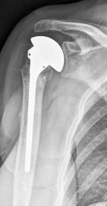 Shoulder Arthritis / Rotator Cuff Tears / Shoulder Pain : Long stem ...