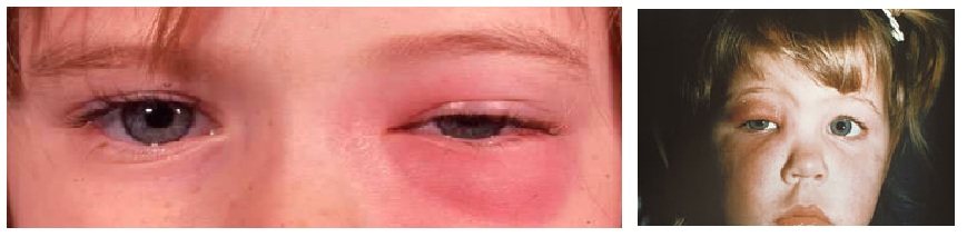 Medicina Baseada em Residência: Diagnóstico diferencial: Sinal de ...