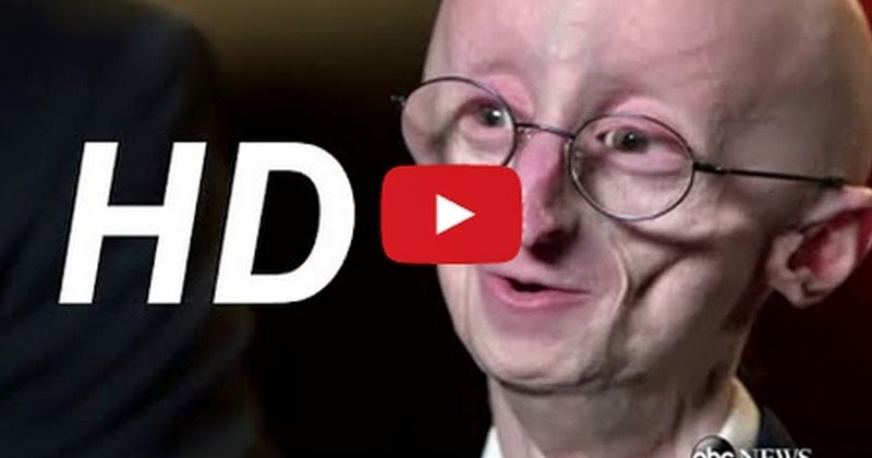 Little Boy Looks Like a 100 Year Old Man ! Rare Disease Progeria - At ...