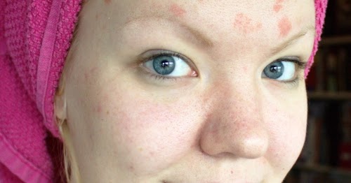 Zoffe's makeup: Psoriasis - dealing with having it on the face.