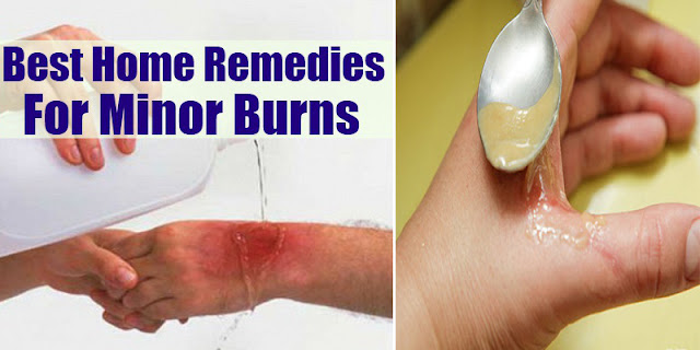 Simple Home Remedies For Minor Burns - Style Hunt World