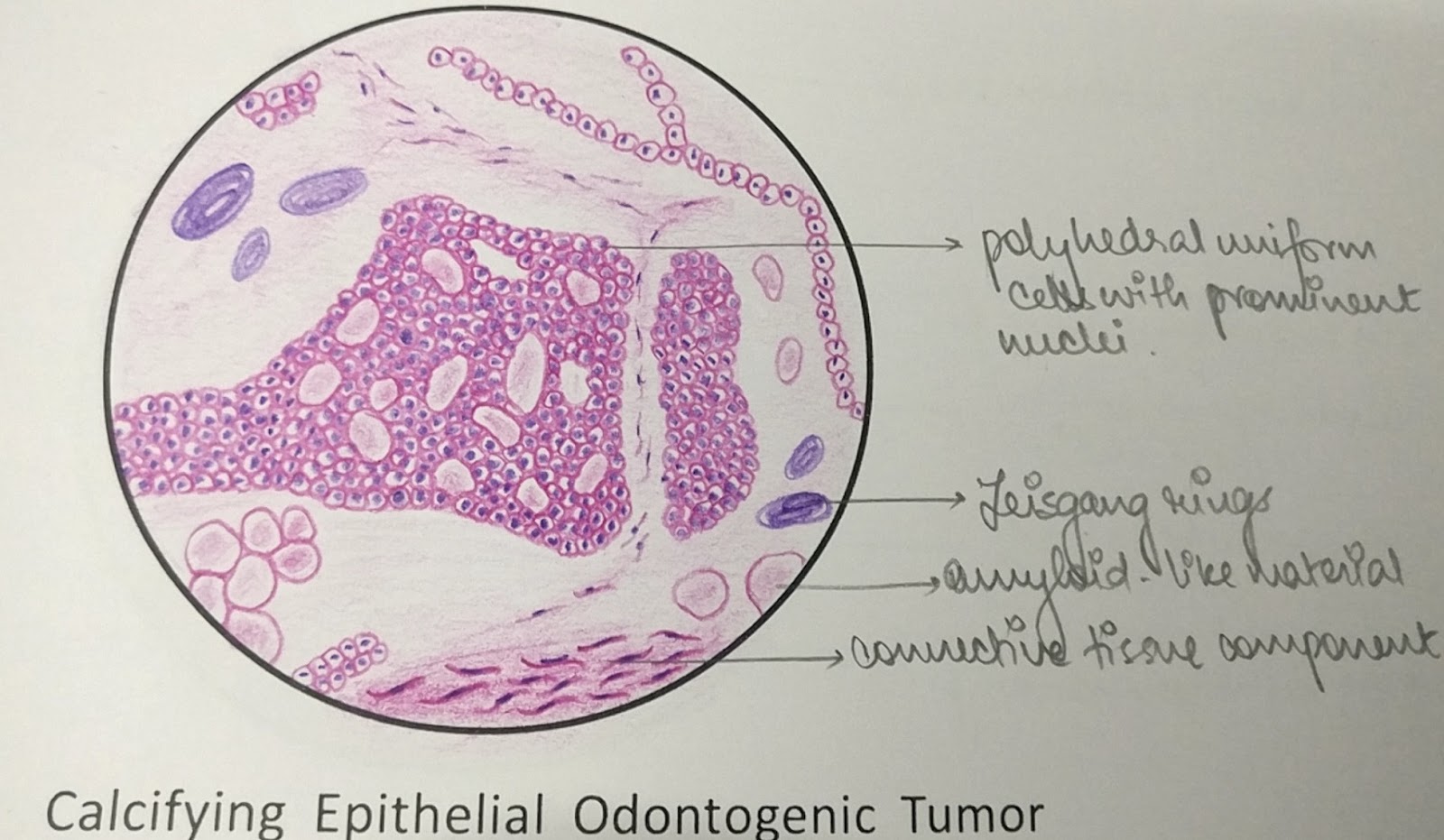 Calcifying Epithelial Odontogenic Tumor Histology