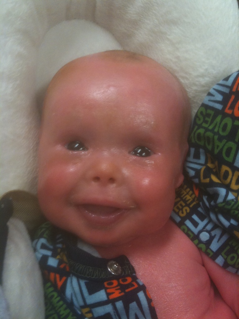 ~Our 'Young Warrior' Evan~ Living with Harlequin Ichthyosis: Cute Stuff