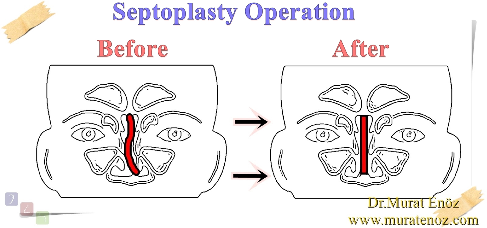 Recovery Time & Postoperative Care After Septoplasty Operation