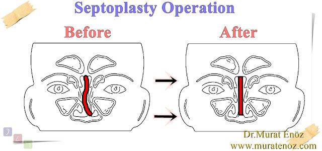Recovery Time & Postoperative Care After Septoplasty Operation