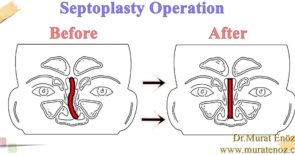 Recovery Time & Postoperative Care After Septoplasty Operation