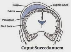 informasi praktis kesehatan anak: Benjolan pada Kepala pada bayi baru lahir